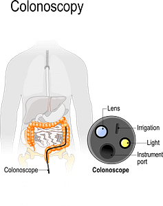 Smithicone Contamination in Endoscope Lumens - AITMedical